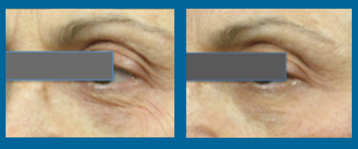 Syneron eMatrix Laser Treatments Before & After Tampa