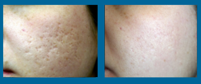 Syneron eMatrix Laser Treatments Before & After Tampa