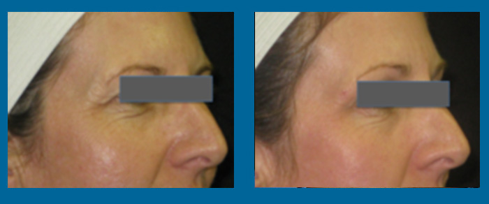 Syneron eMatrix Laser Treatments Before & After Tampa